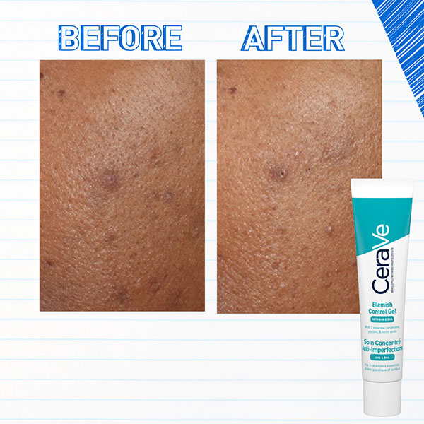 Complete Acne Guide: Treat, Repair & Break the Cycle | CeraVe India